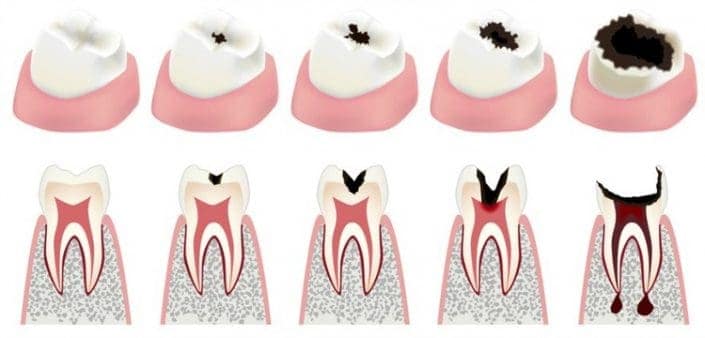 ¿Sabes identificar una caries? - Clínica Dental Benalua