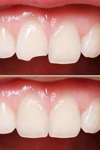¿Cómo se arregla un diente roto? - Clínica Dental Benalua