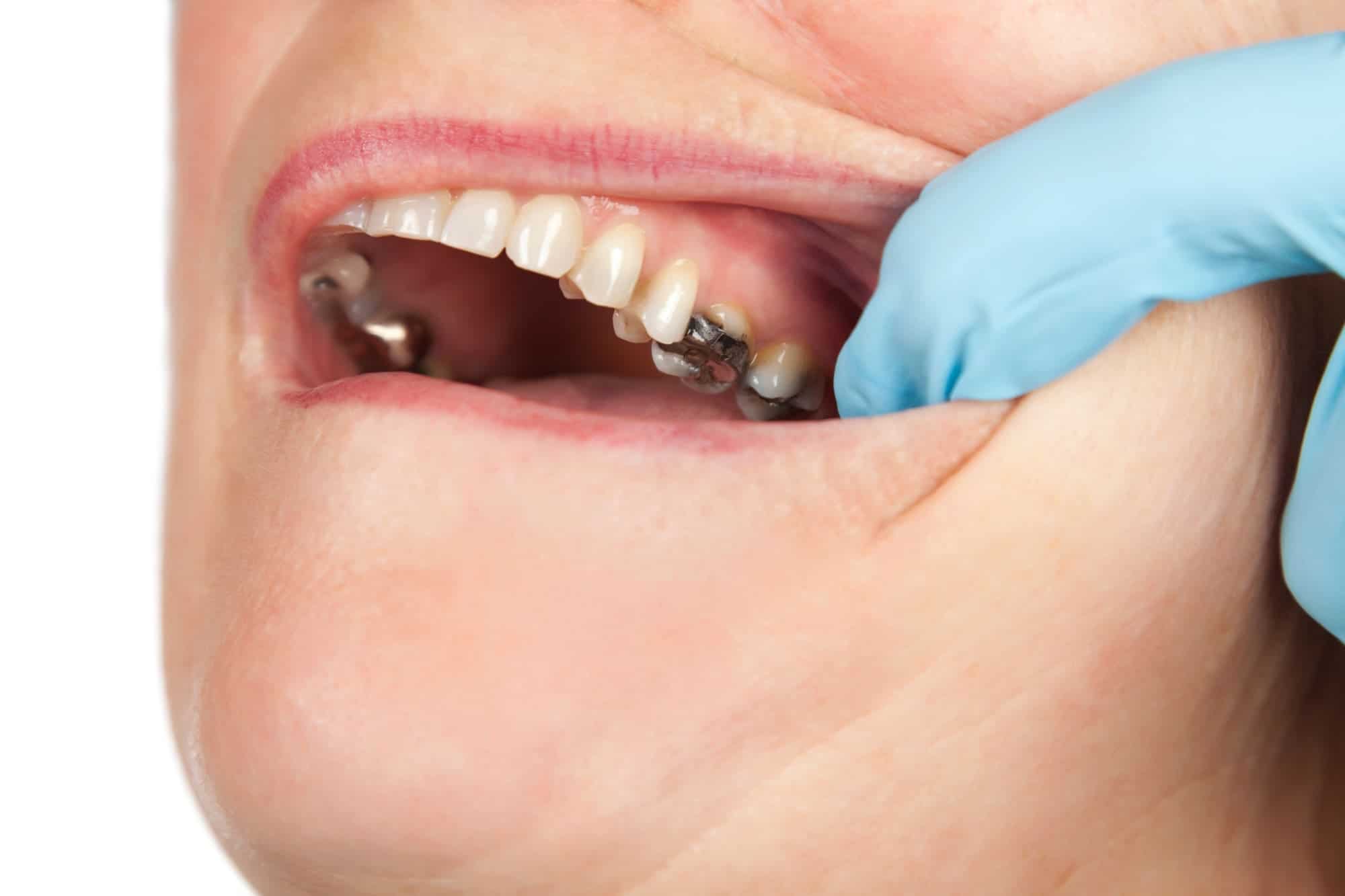 Dientes Negros Japoneses