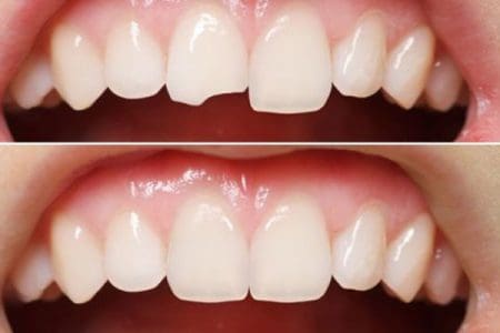 Qué hacer si se astilla o se rompe un diente - Clínica Dental Benalua